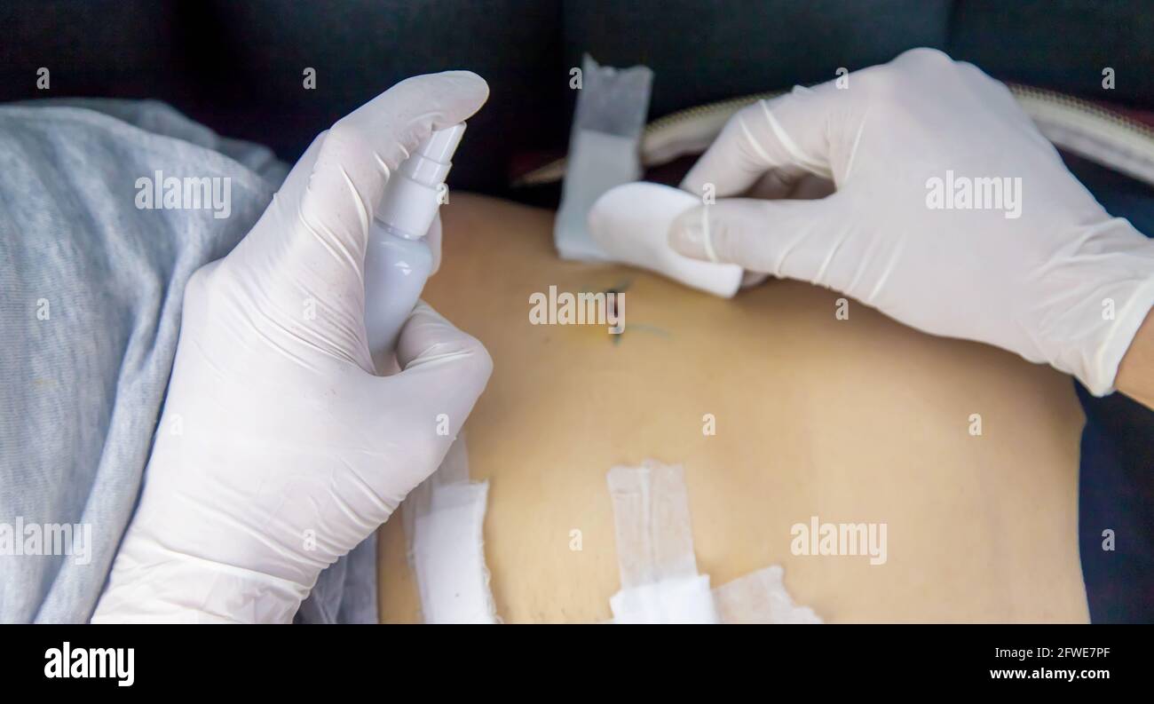 Appendix scar hi-res stock photography and images - Alamy