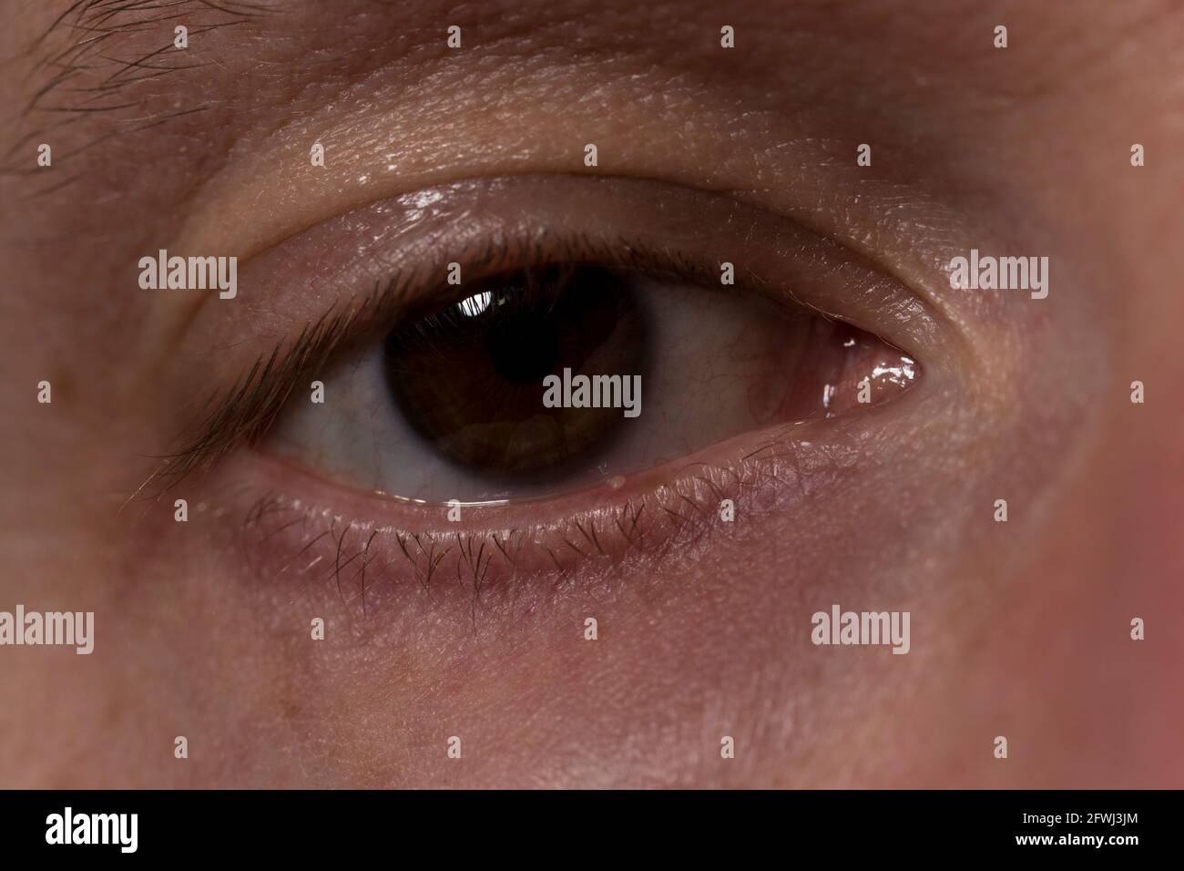 Chalazion cyst hi-res stock photography and images - Alamy