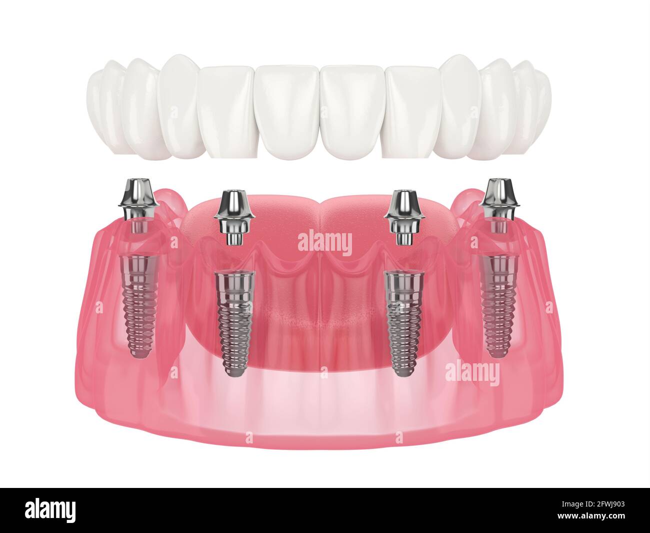 Mandibular prosthesis all on 4 system supported by over white ...