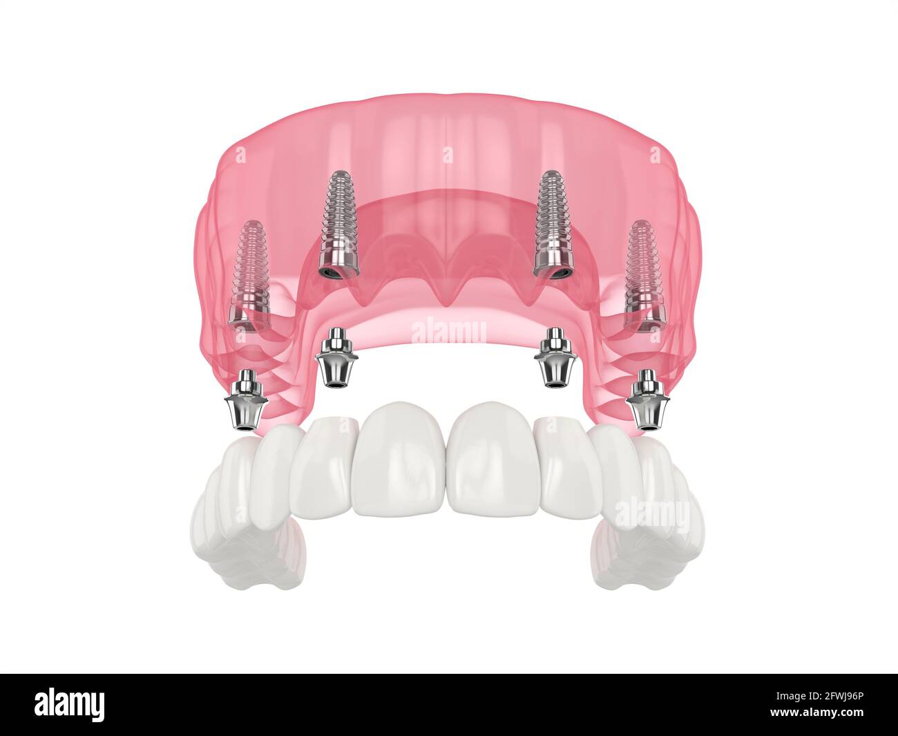 Mandibular prosthesis all on 4 system supported by over white ...