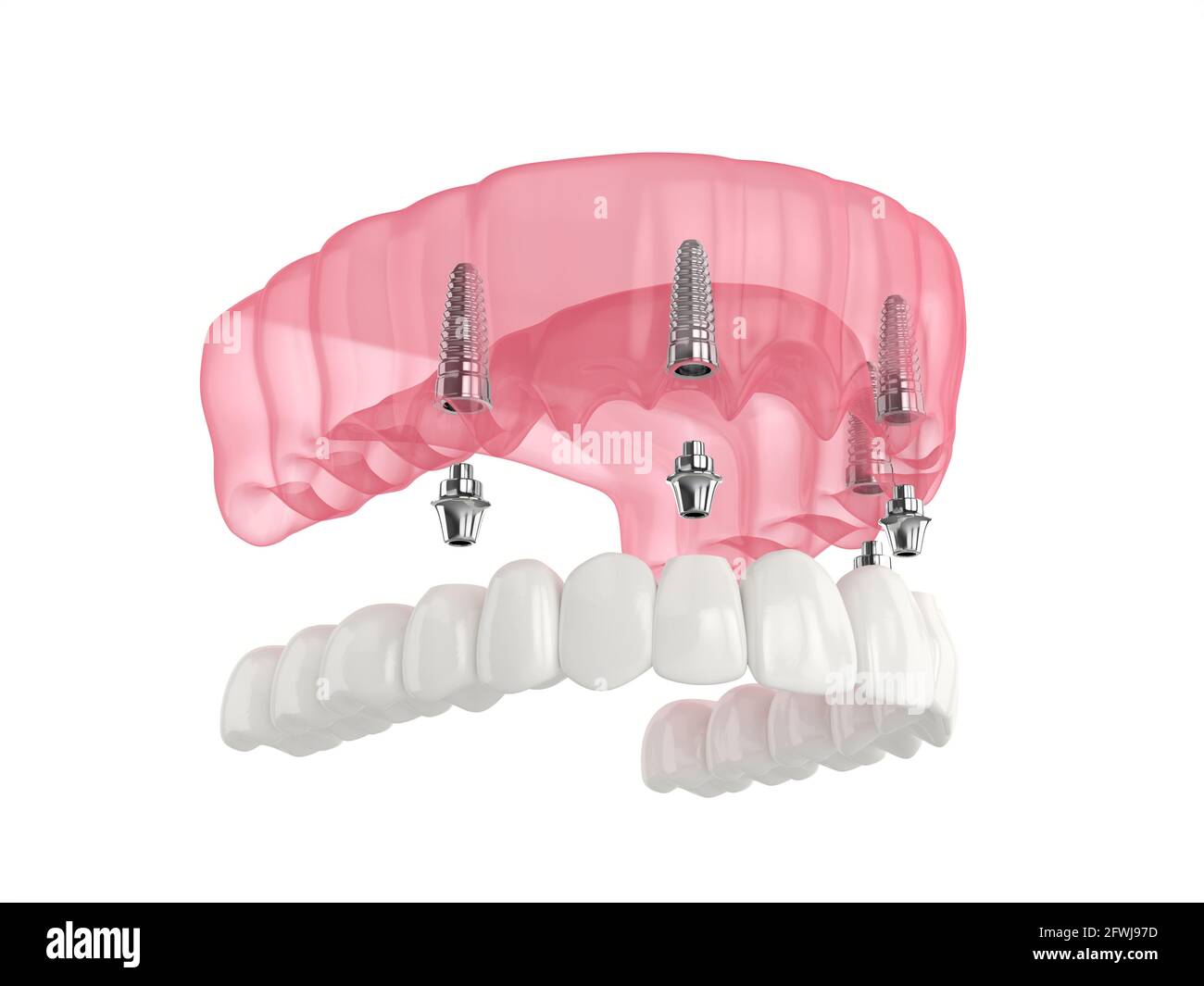 Mandibular prosthesis all on 4 system supported by over white ...