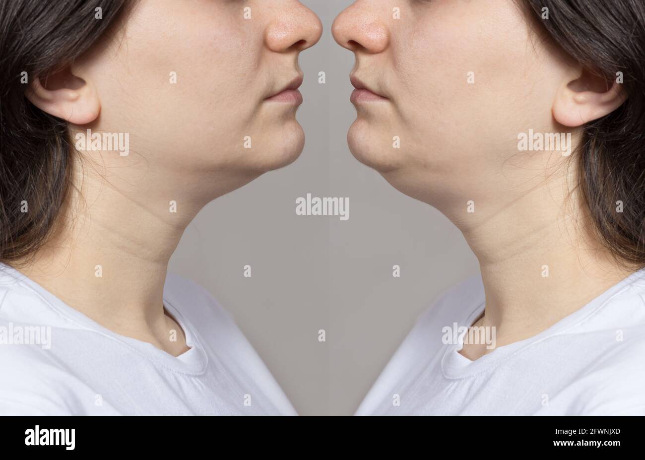 The woman has a double chin. Chin reshaping, fat removal, lifting ...