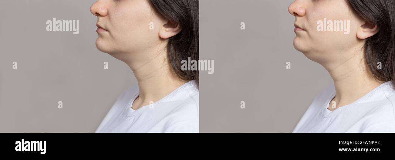 The woman has a double chin. Chin reshaping, fat removal, lifting ...