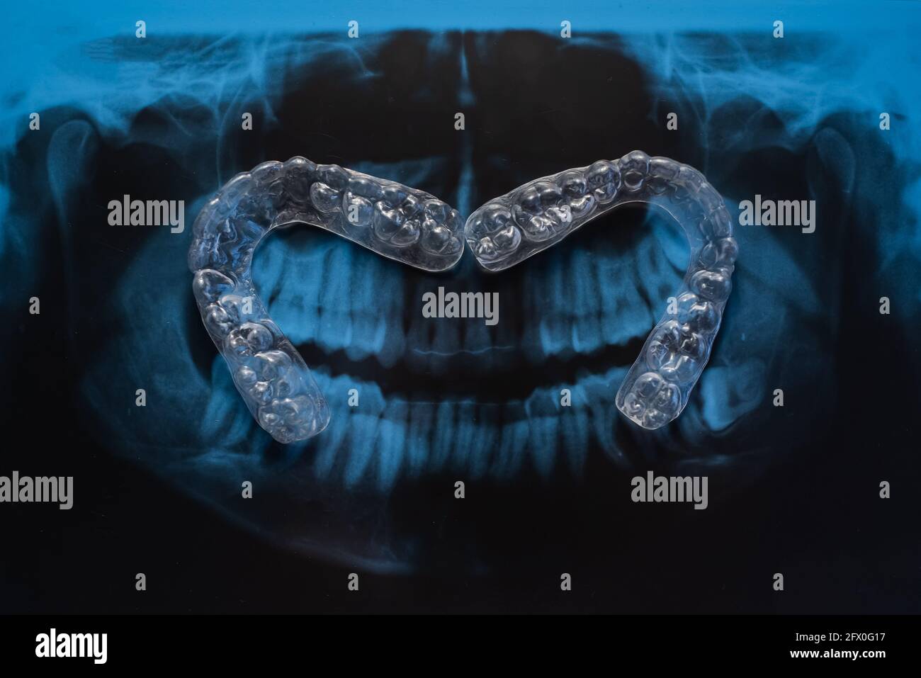 Transparent bite correction trays and x-ray of the jaw. Orthodontist ...