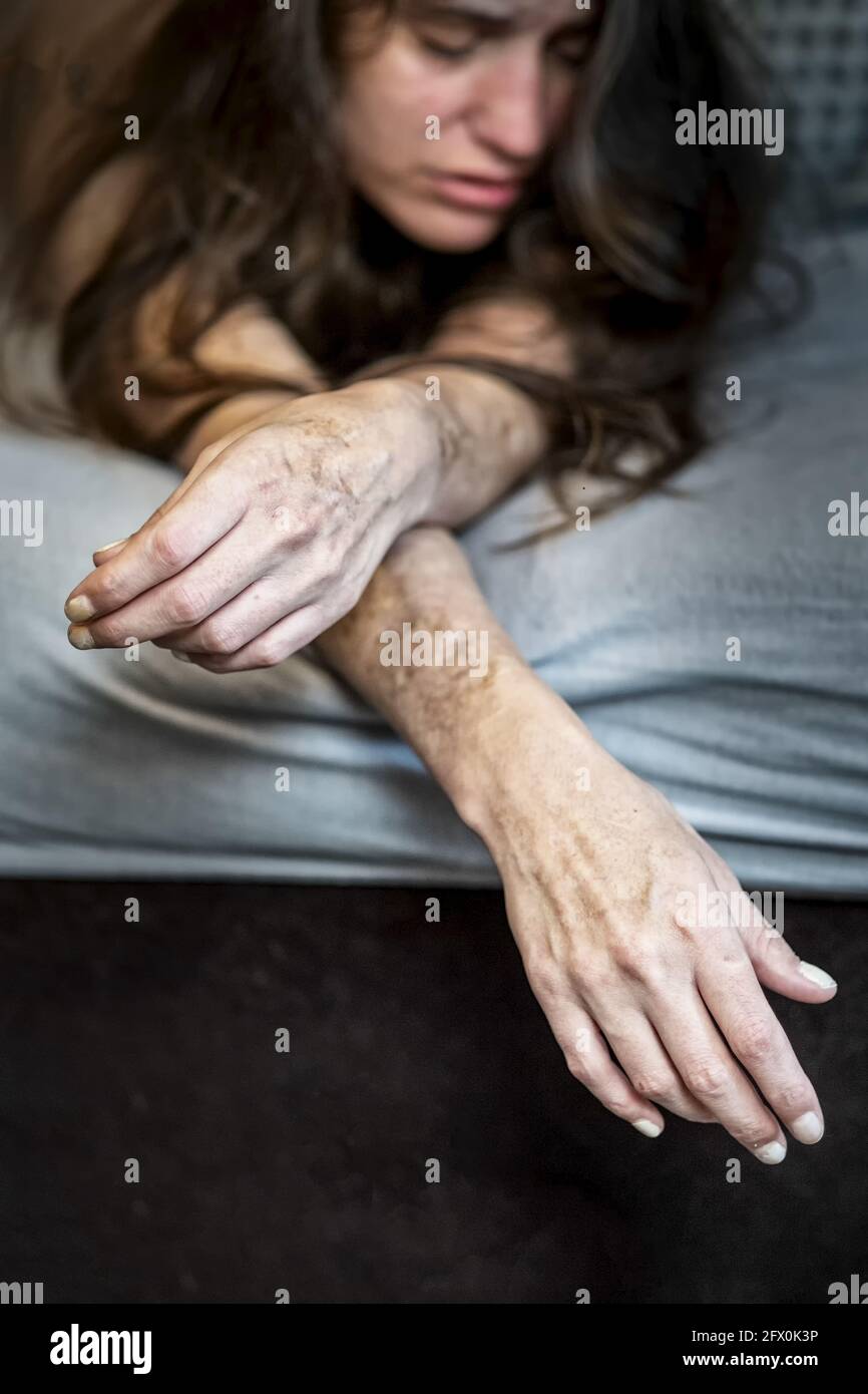 Scars arm hi-res stock photography and images - Alamy