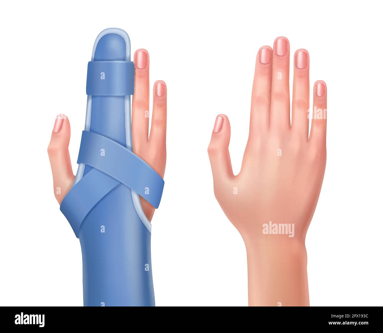 Finger Splint High Resolution Stock Photography and Images - Alamy