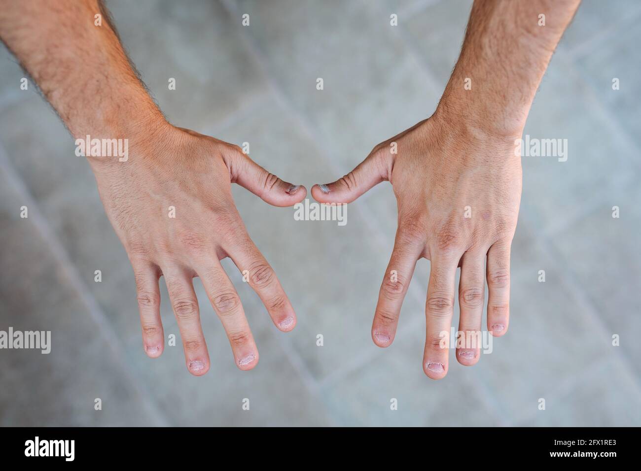 Finger nails bad condition hi-res stock photography and images - Alamy
