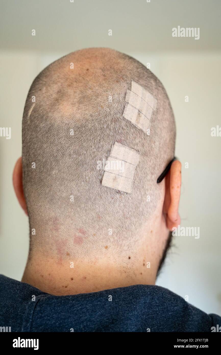 A man with two wounds on the back of his head covered with plasters ...