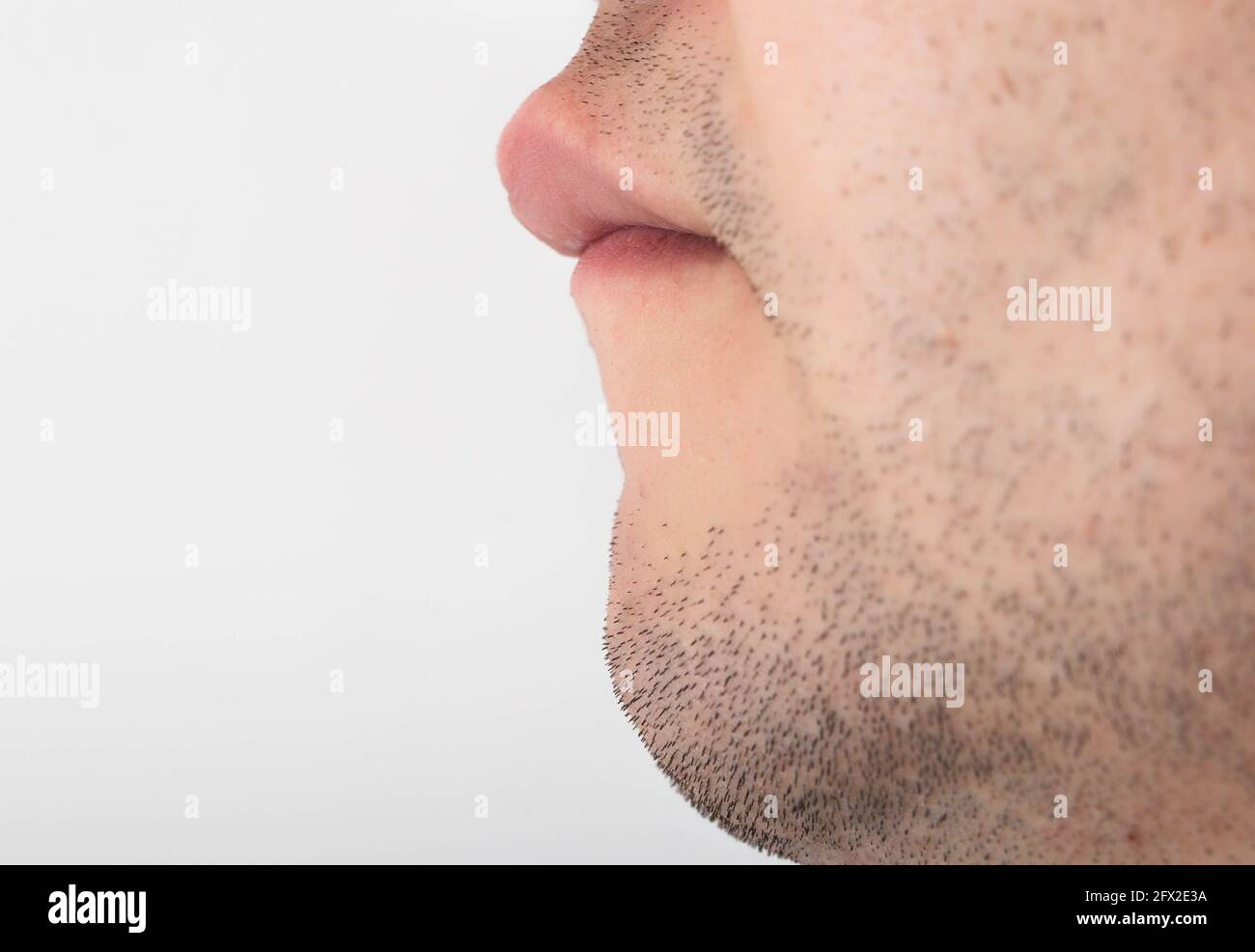 A man has a large upper lip, close-up. Reduction and correction of lips ...