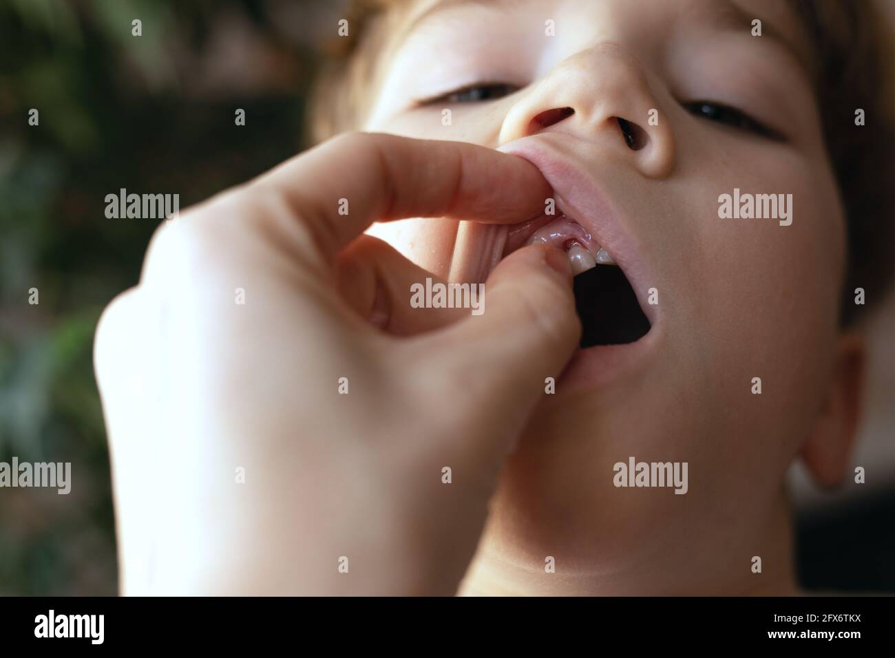 Wobbly tooth hi-res stock photography and images - Alamy