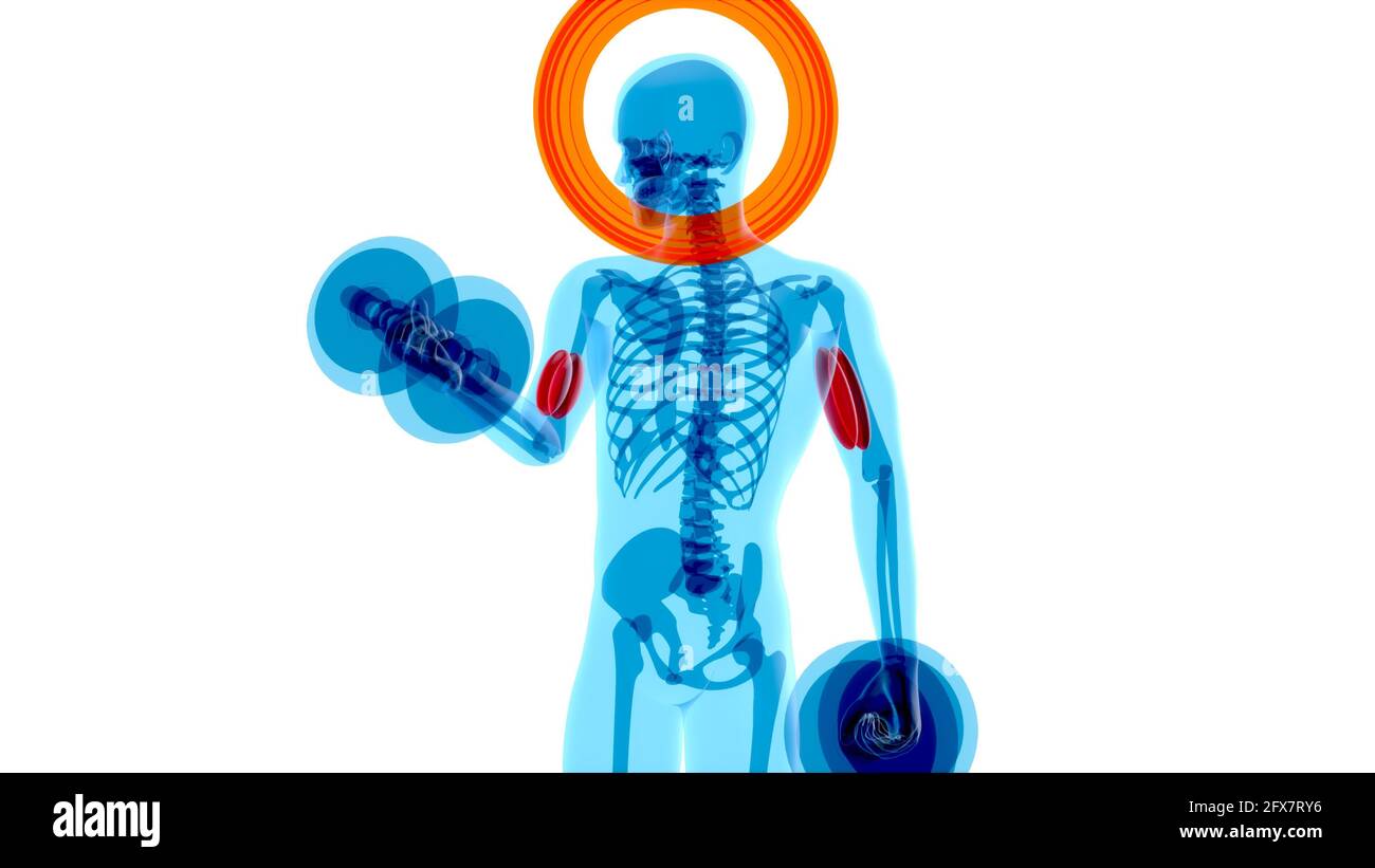 X Ray Burn High Resolution Stock Photography and Images - Alamy