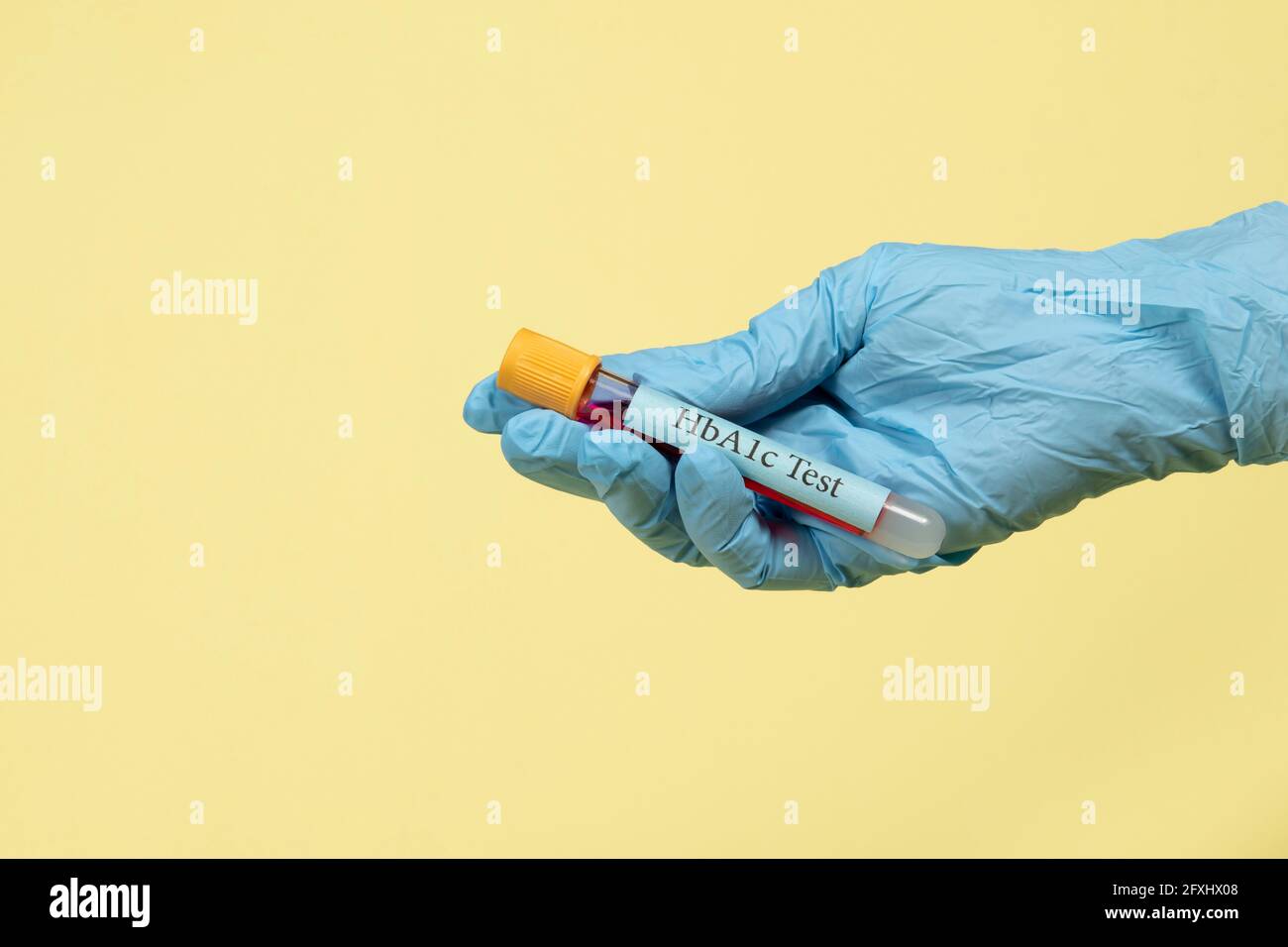 Blood sample in a vacuum tube for hemoglobin HbA1c test diabetes ...