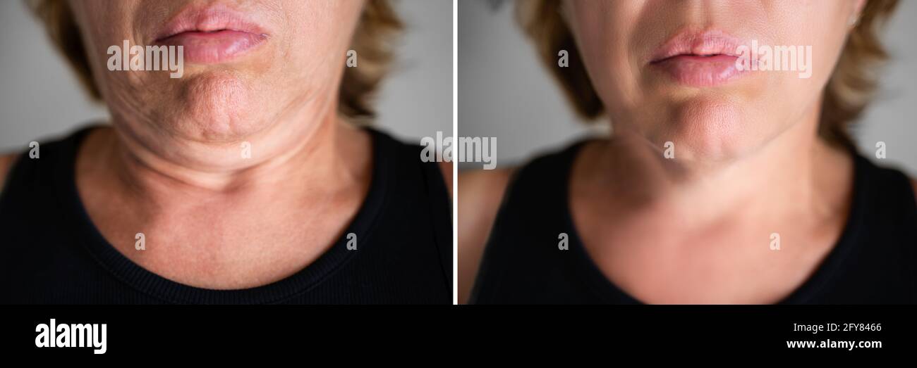 Double Chin Face Injection And Plastic Surgery Stock Photo - Alamy