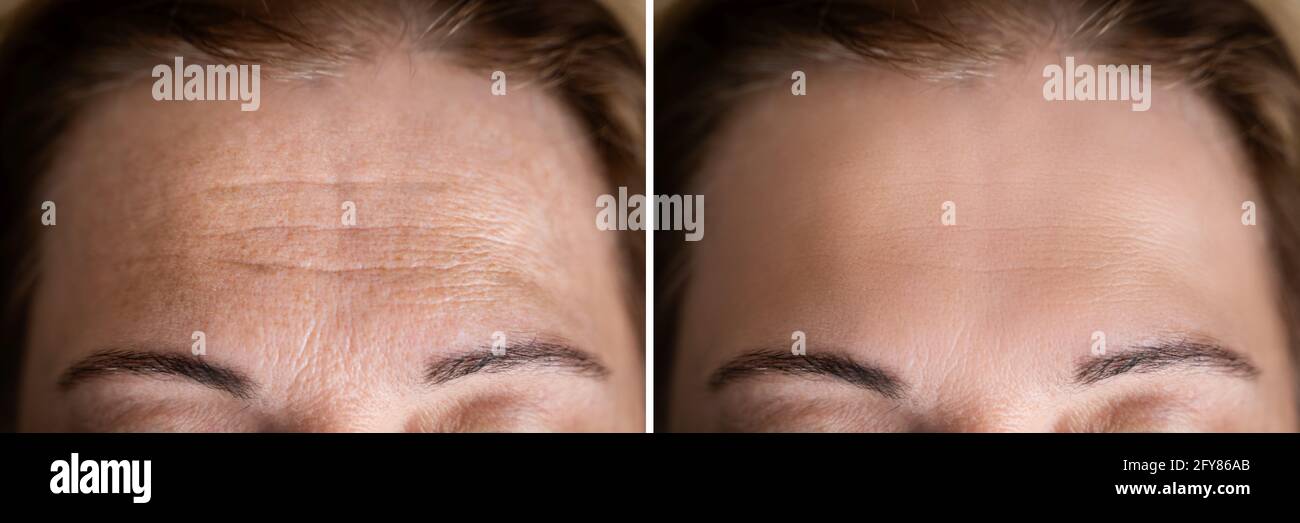 Wrinkled Face Before And After