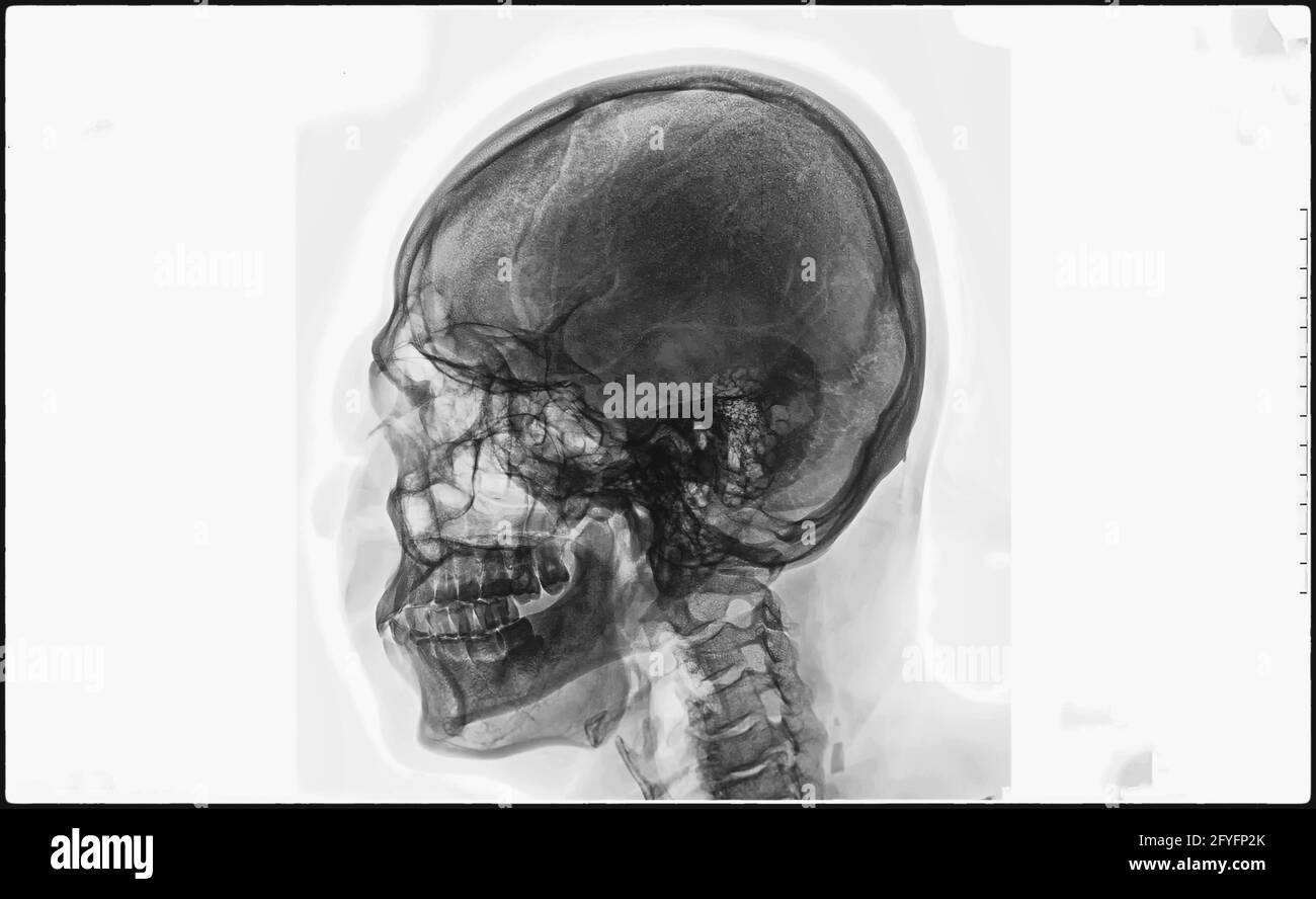 Film x-ray skull and cervical spine lateral view, X-Ray film of human ...