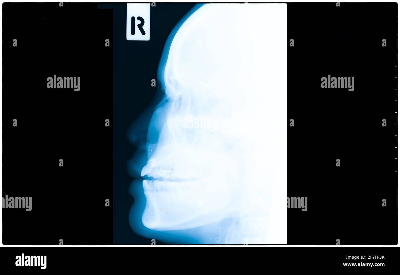 Film x-ray skull and cervical spine lateral view, X-Ray film of human ...