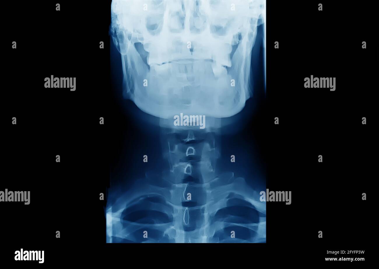 Film x-ray skull and cervical spine lateral view, X-Ray film of human ...