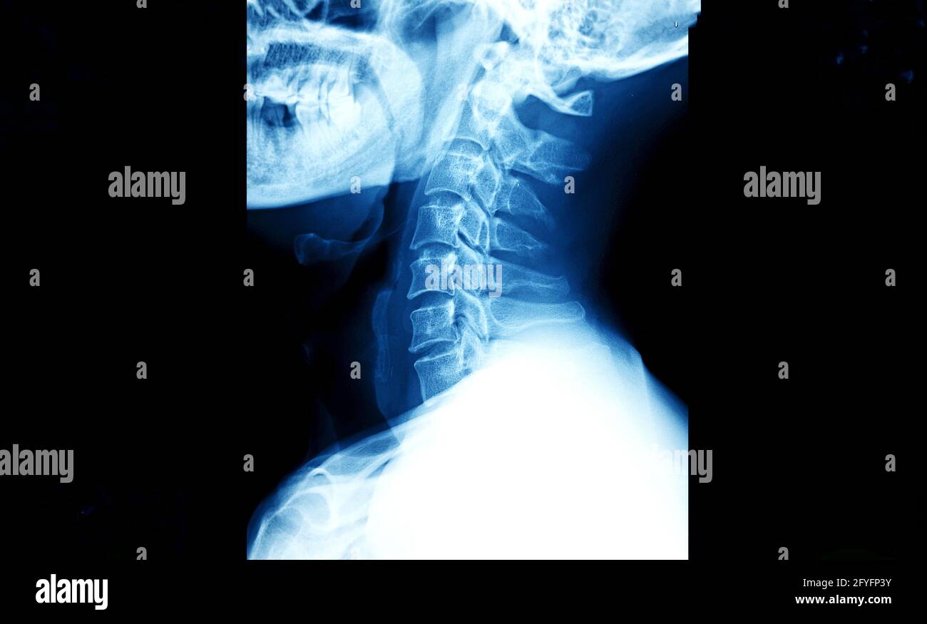 Spine lateral view hi-res stock photography and images - Alamy