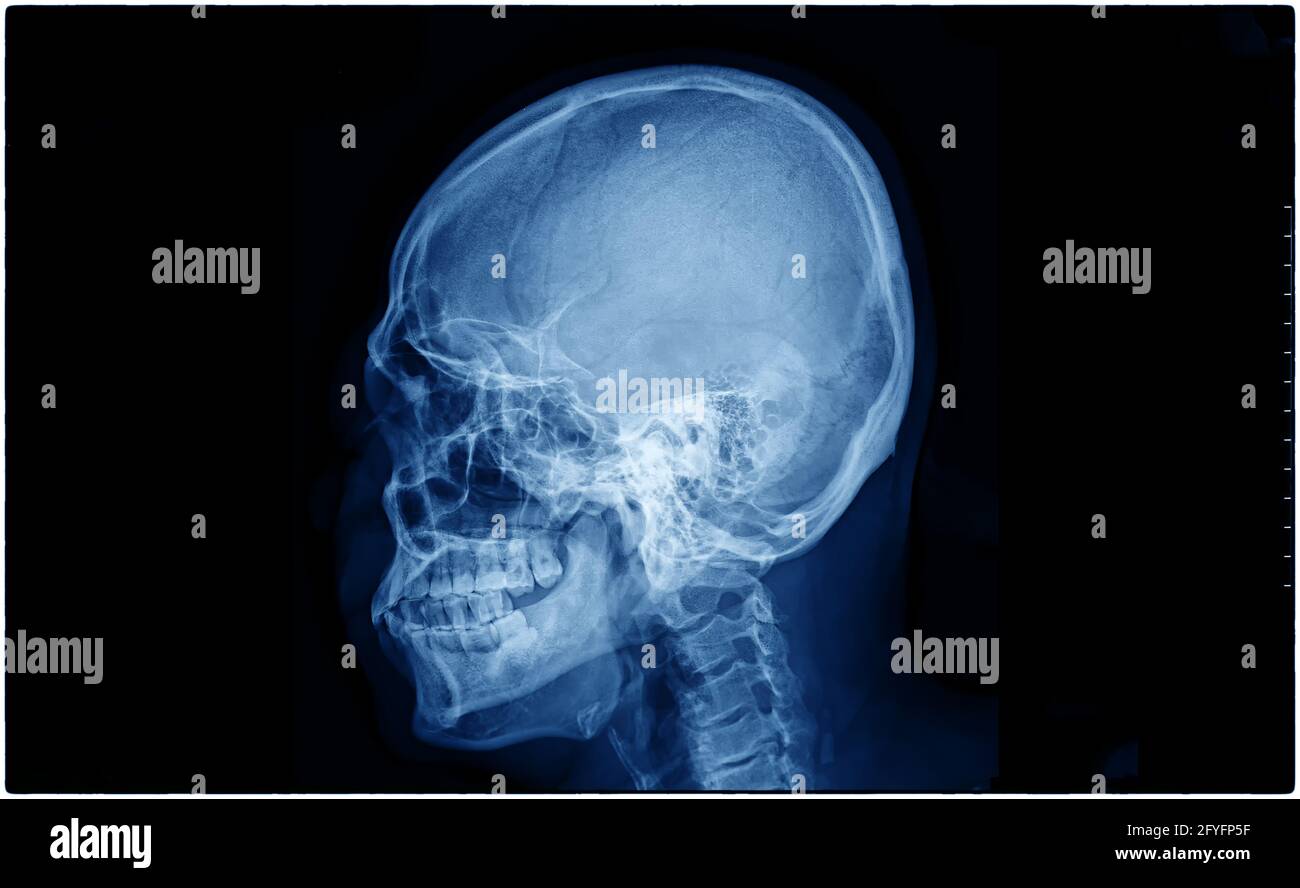 Film x-ray skull and cervical spine lateral view, X-Ray film of human ...