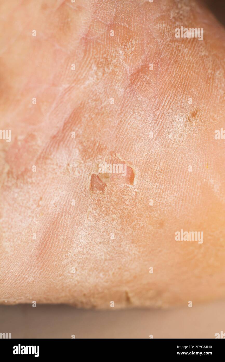 Closeup of the legs of a woman suffering from chronic psoriasis on a ...