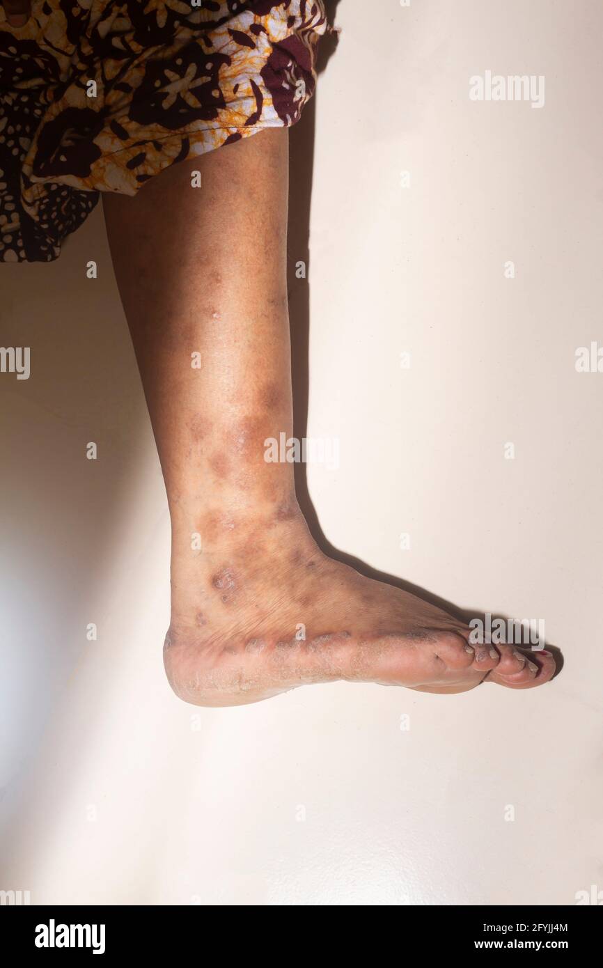 Closeup of the legs of a woman suffering from chronic psoriasis on a ...