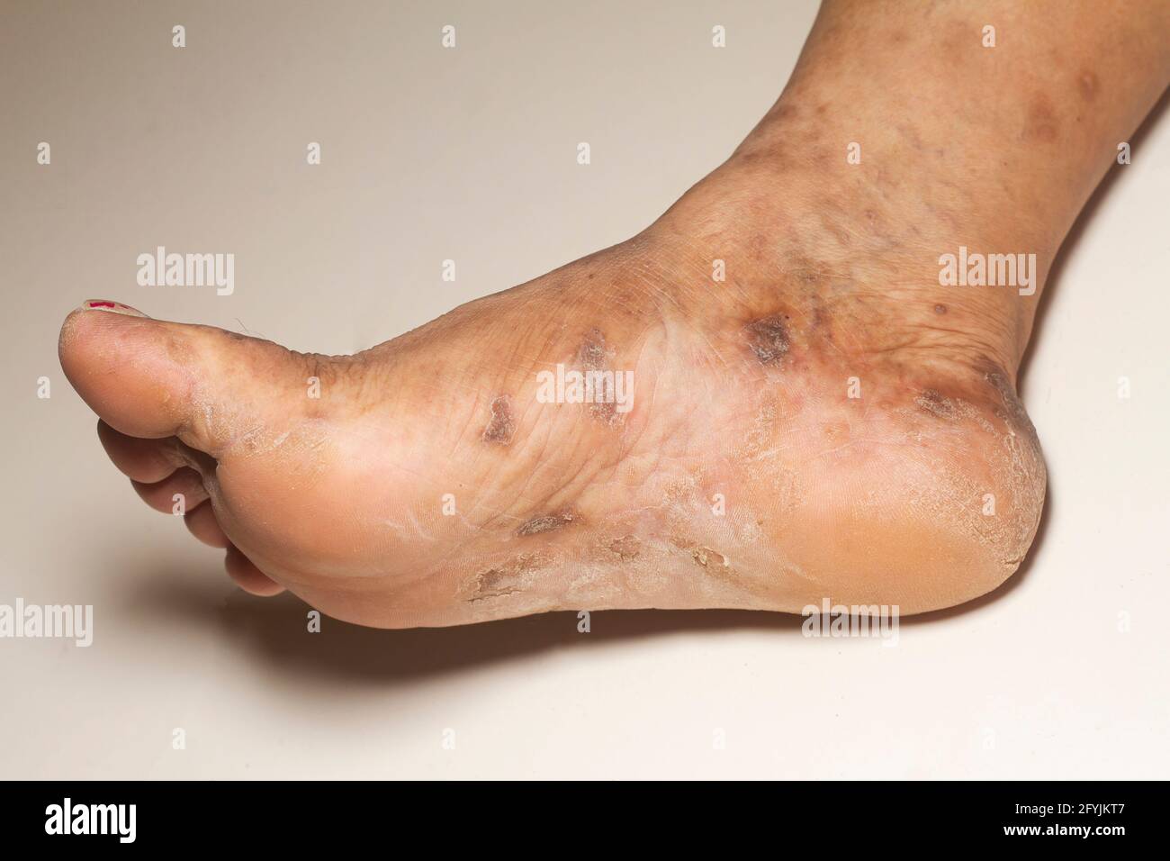Closeup of the legs of a woman suffering from chronic psoriasis on a ...