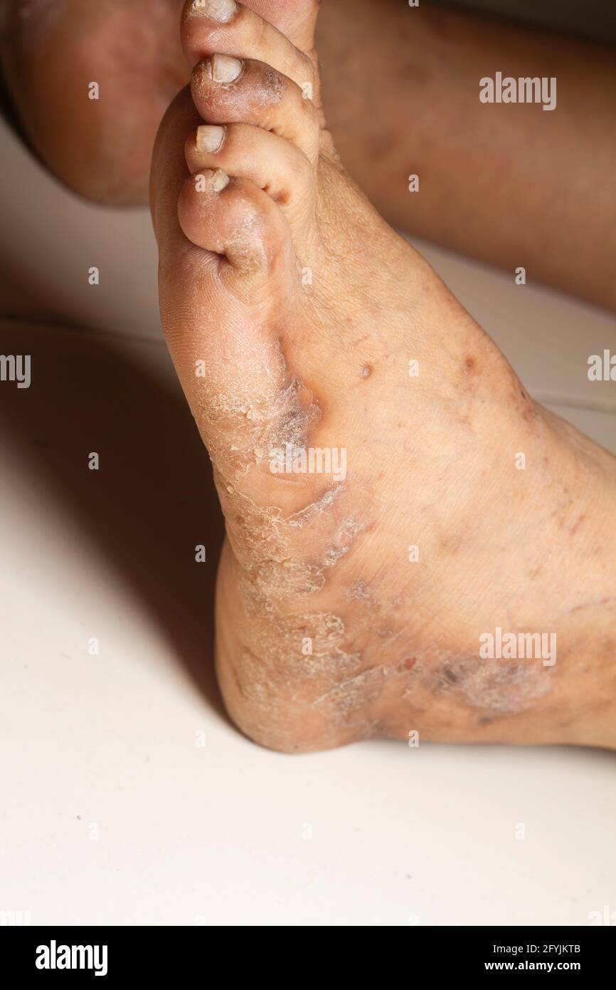 Woman with rash on her legs hi-res stock photography and images - Alamy
