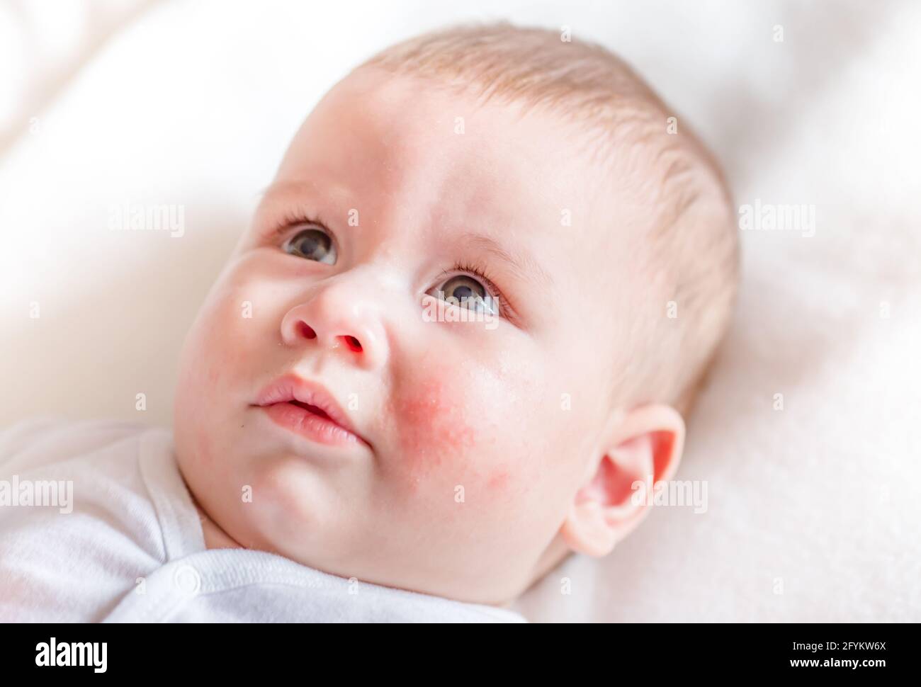 LONDON, UNITED KINGDOM - Aug 27, 2020: Atopic dermatitis eczema in baby ...