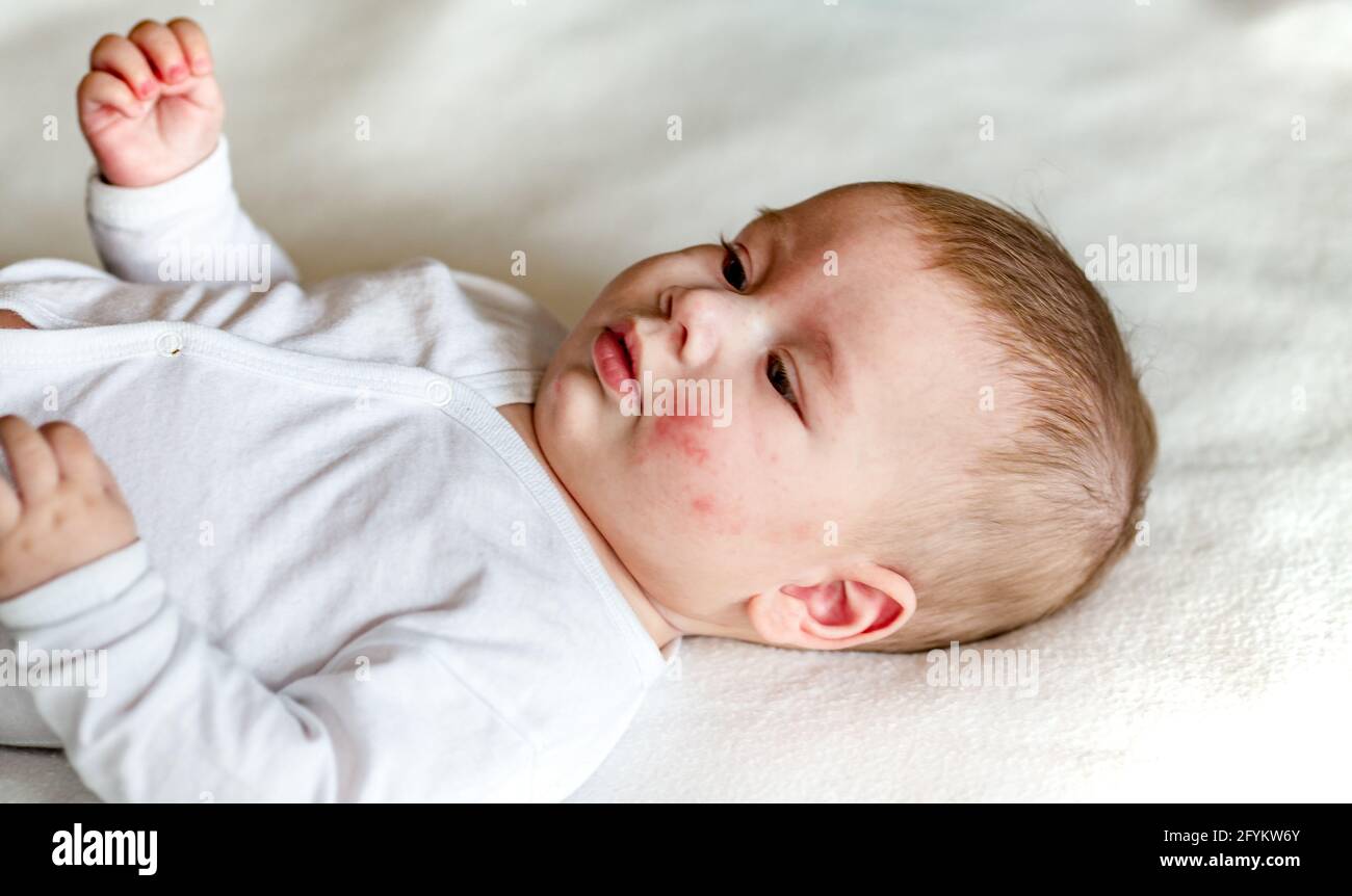 LONDON, UNITED KINGDOM - Aug 27, 2020: Atopic dermatitis eczema in baby ...