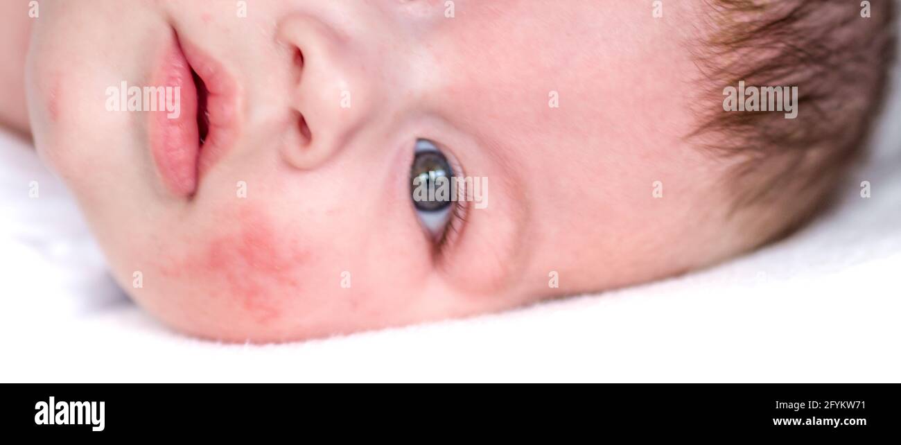 LONDON, UNITED KINGDOM - Aug 27, 2020: Atopic dermatitis eczema in baby ...