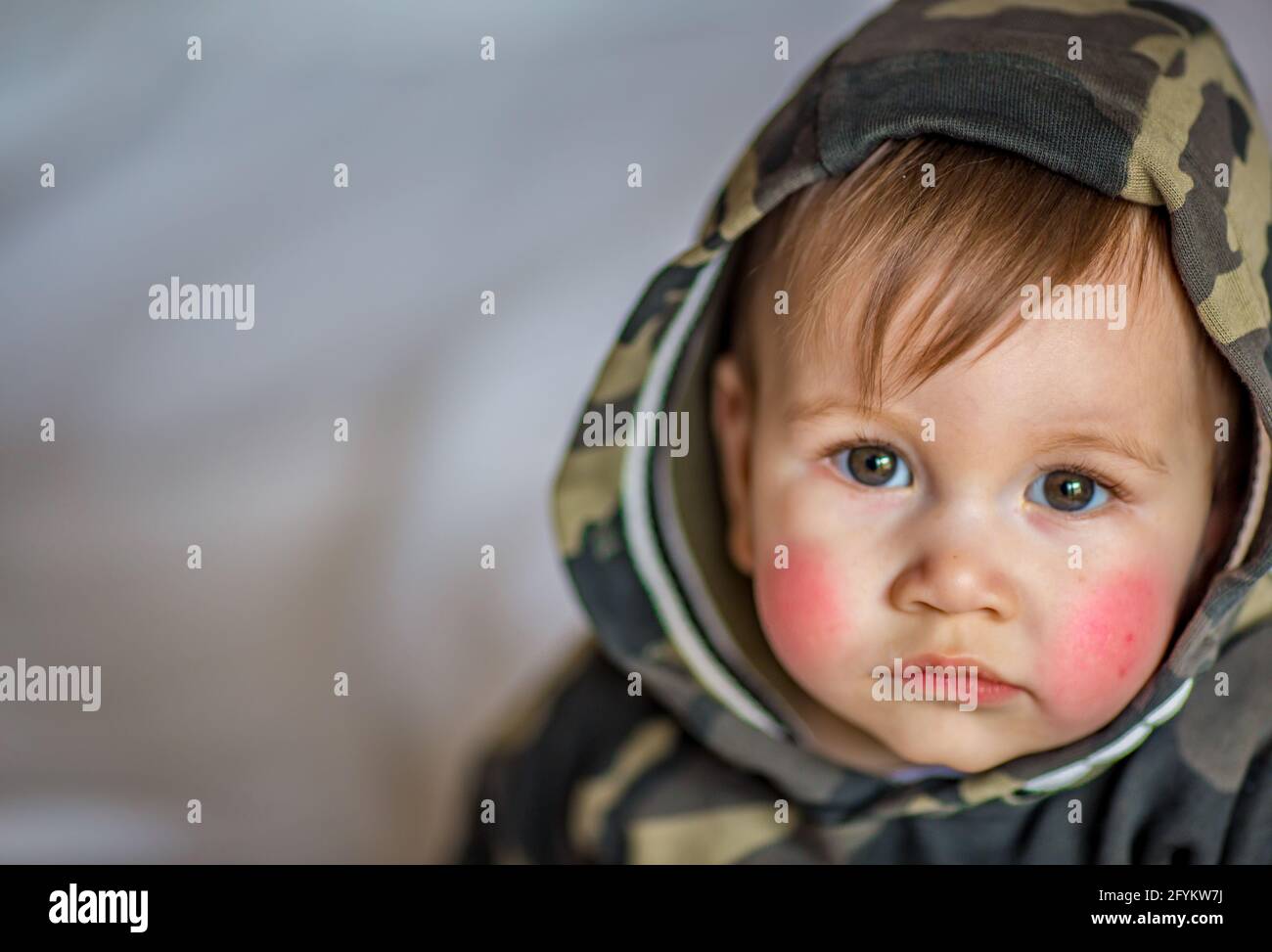 LONDON, UNITED KINGDOM - Aug 27, 2020: Atopic dermatitis eczema in baby ...