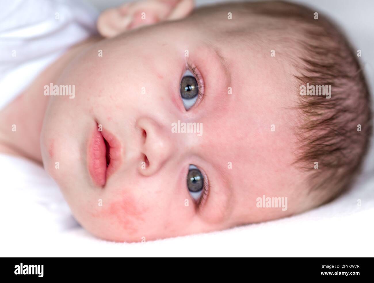 LONDON, UNITED KINGDOM - Aug 27, 2020: Atopic dermatitis eczema in baby ...