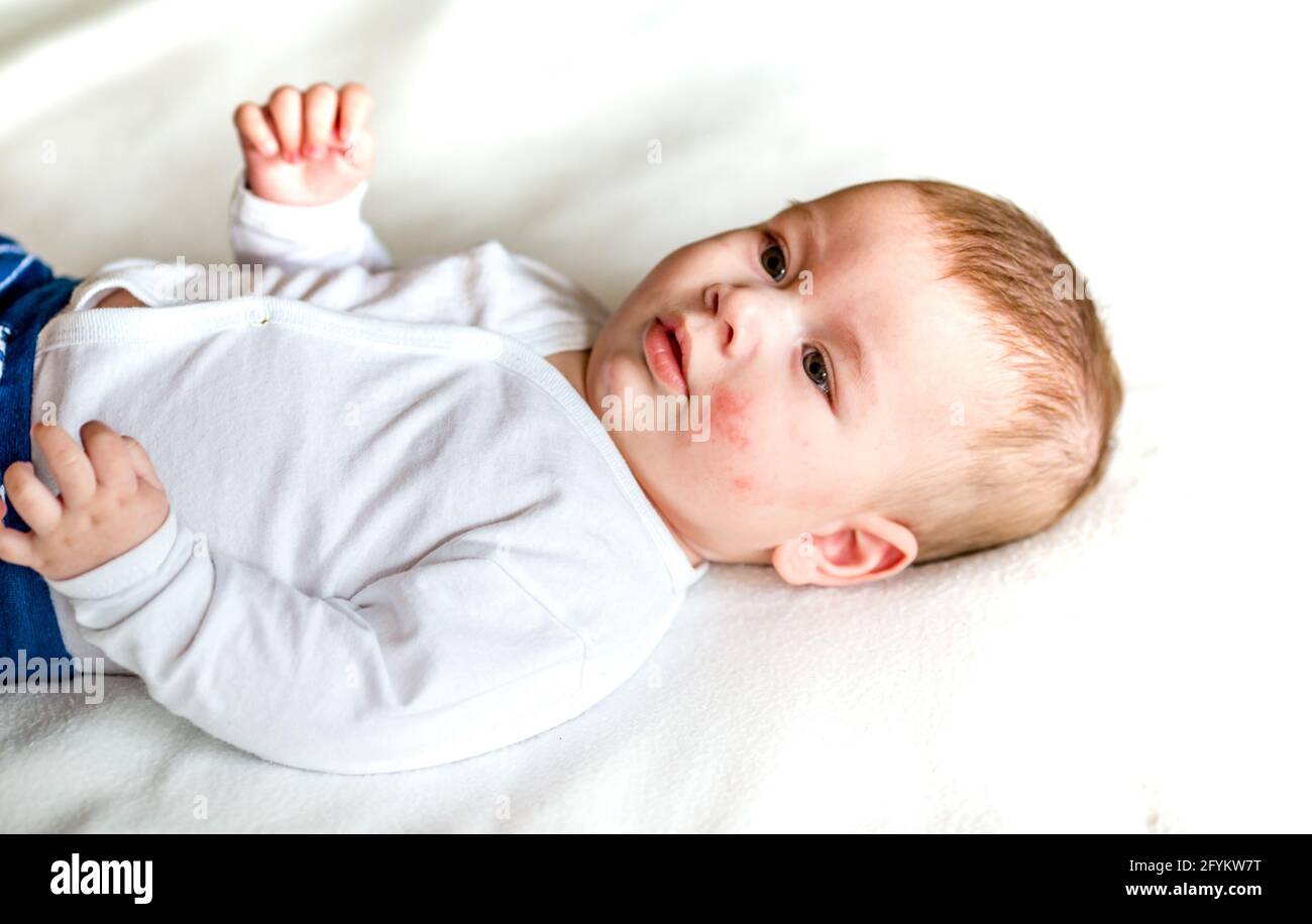 LONDON, UNITED KINGDOM - Aug 27, 2020: Atopic dermatitis eczema in baby ...