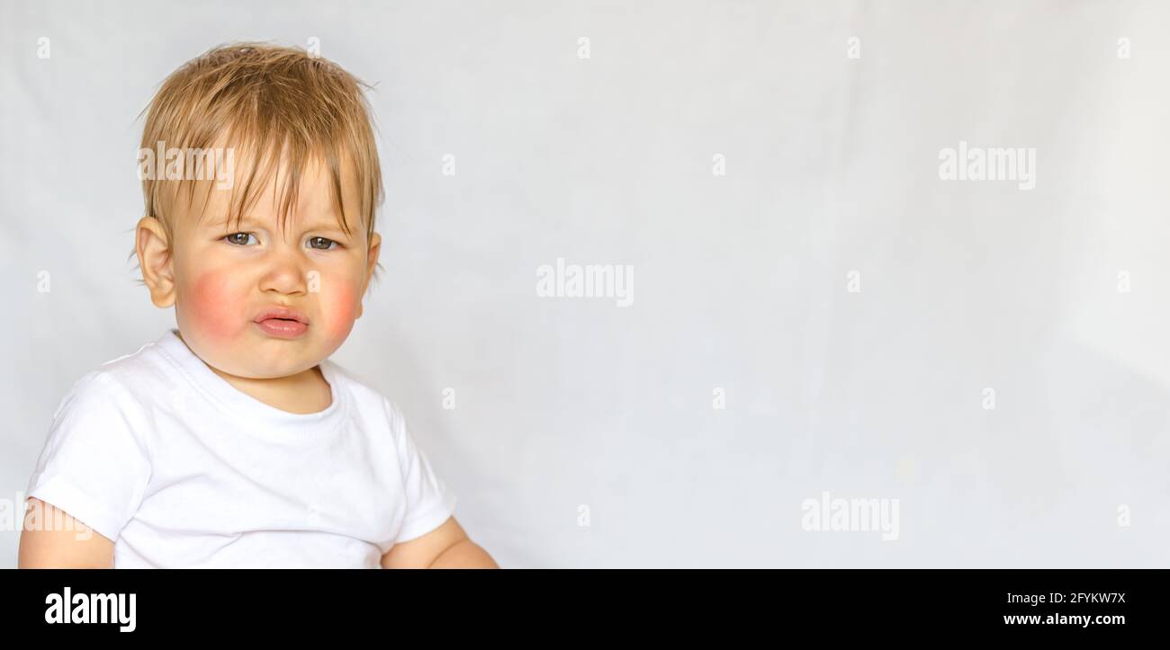LONDON, UNITED KINGDOM - Aug 27, 2020: Atopic dermatitis eczema in baby ...