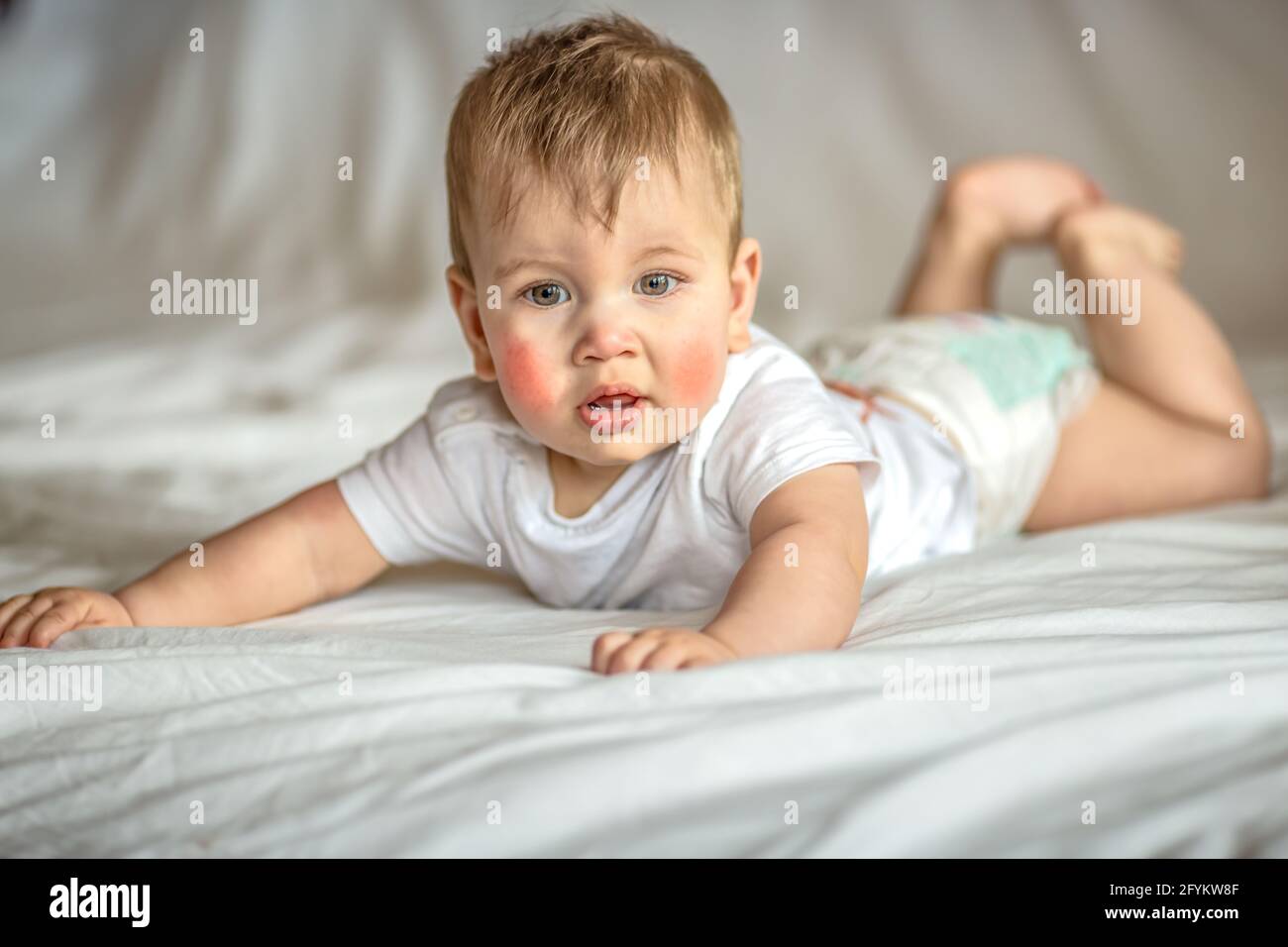 LONDON, UNITED KINGDOM - Aug 27, 2020: Atopic dermatitis eczema in baby ...