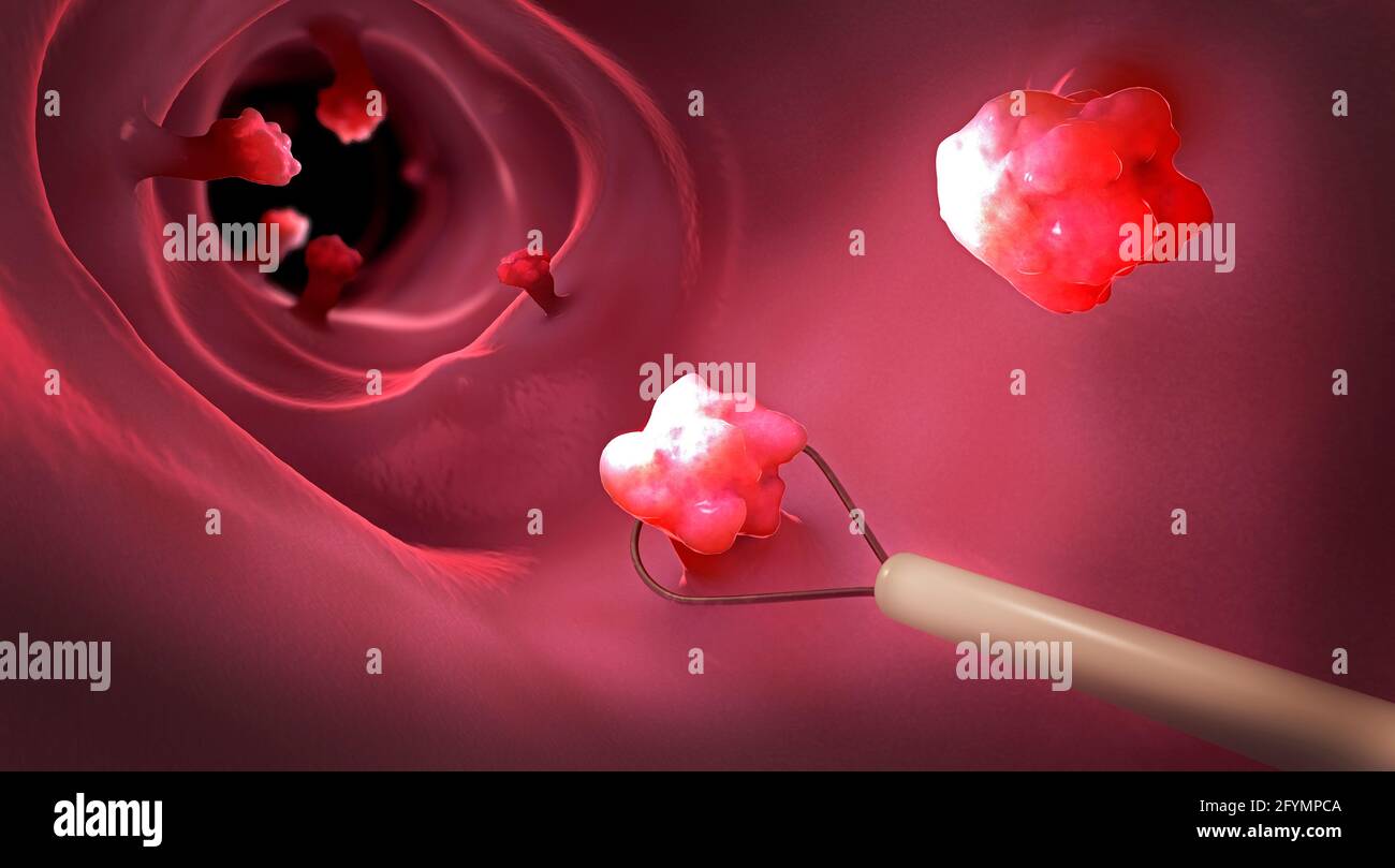 Removal of a colonic polyp, illustration Stock Photo - Alamy