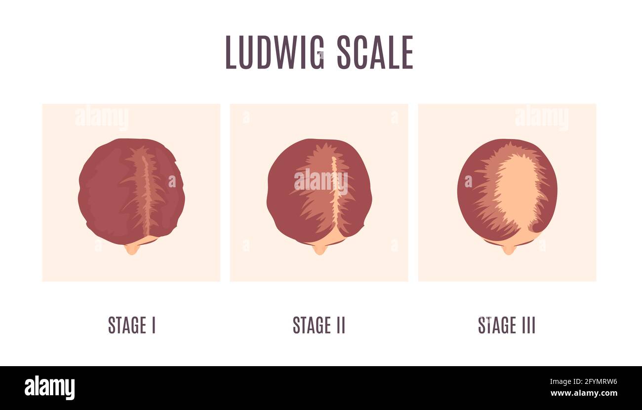 Ludwig scale of baldness in women Stock Photo - Alamy