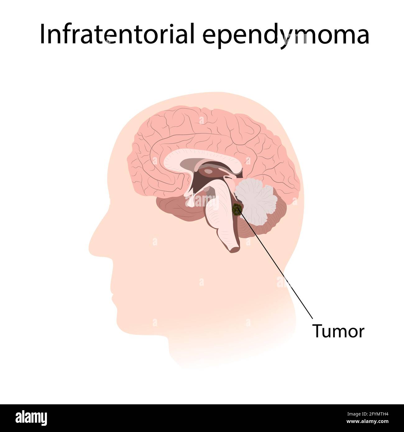 Ependymoma hi-res stock photography and images - Alamy