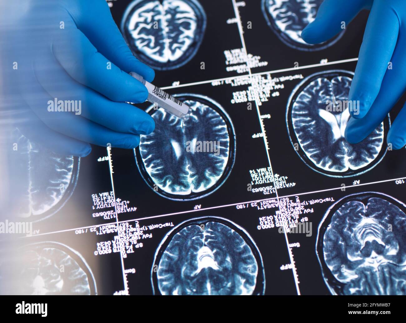 Neurology clinical trial, conceptual image Stock Photo - Alamy