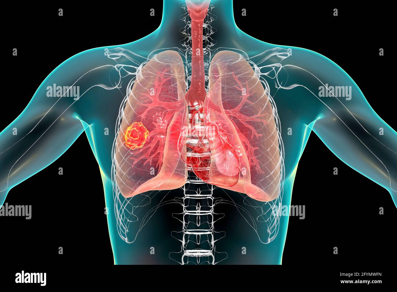 Pulmonary mucormycosis, illustration Stock Photo - Alamy