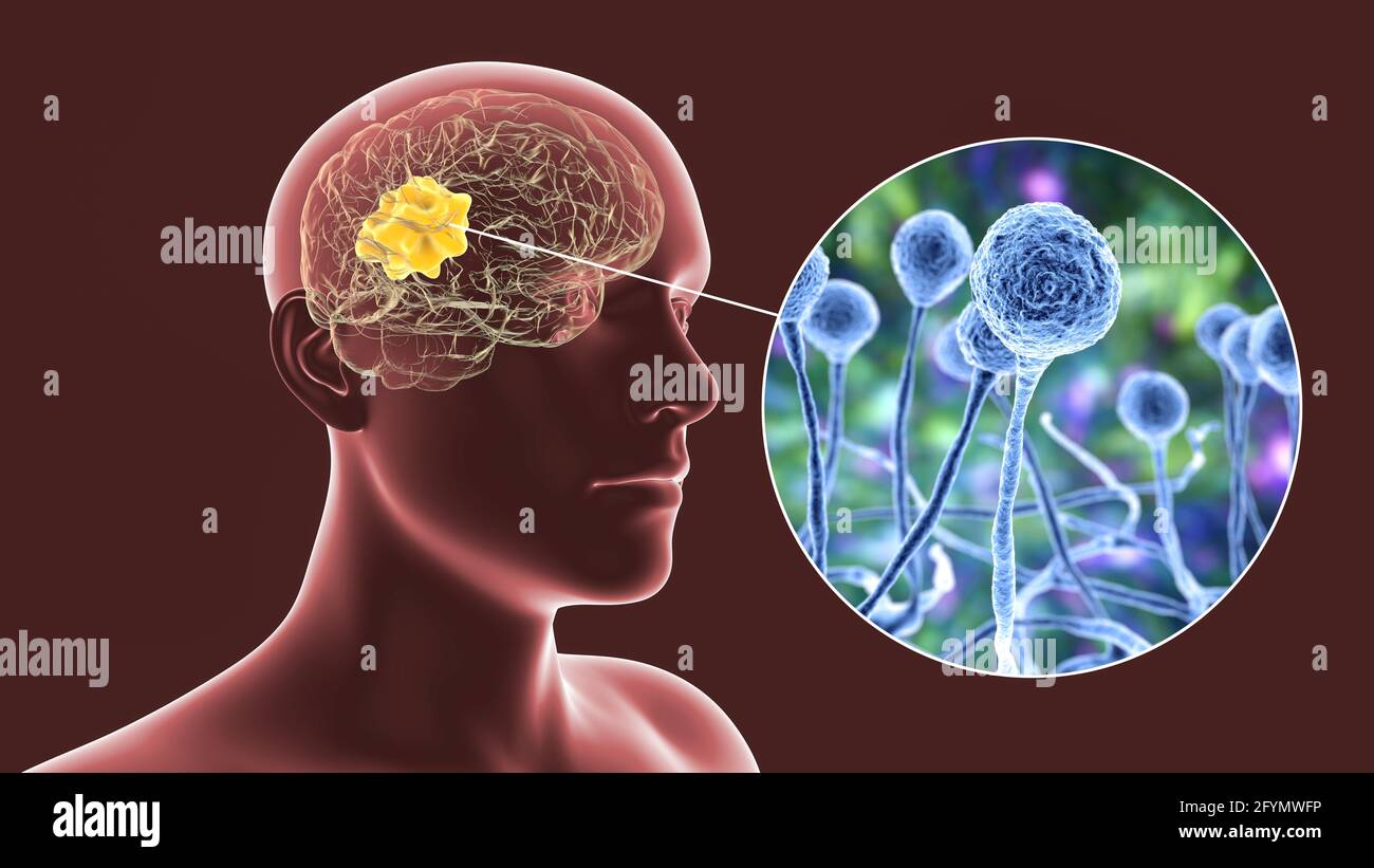 Brain mucormycosis, illustration Stock Photo - Alamy