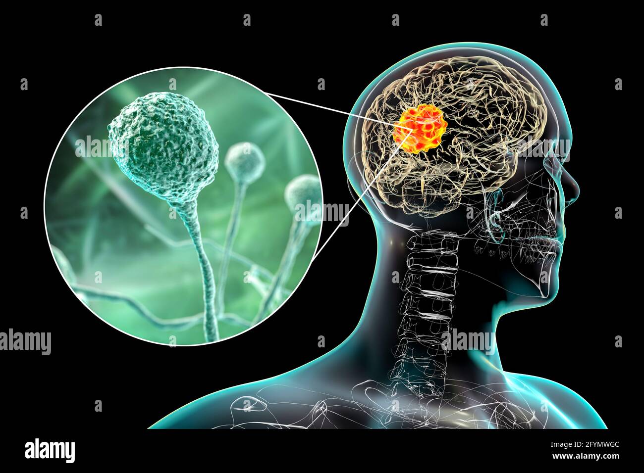 Brain mucormycosis, illustration Stock Photo - Alamy