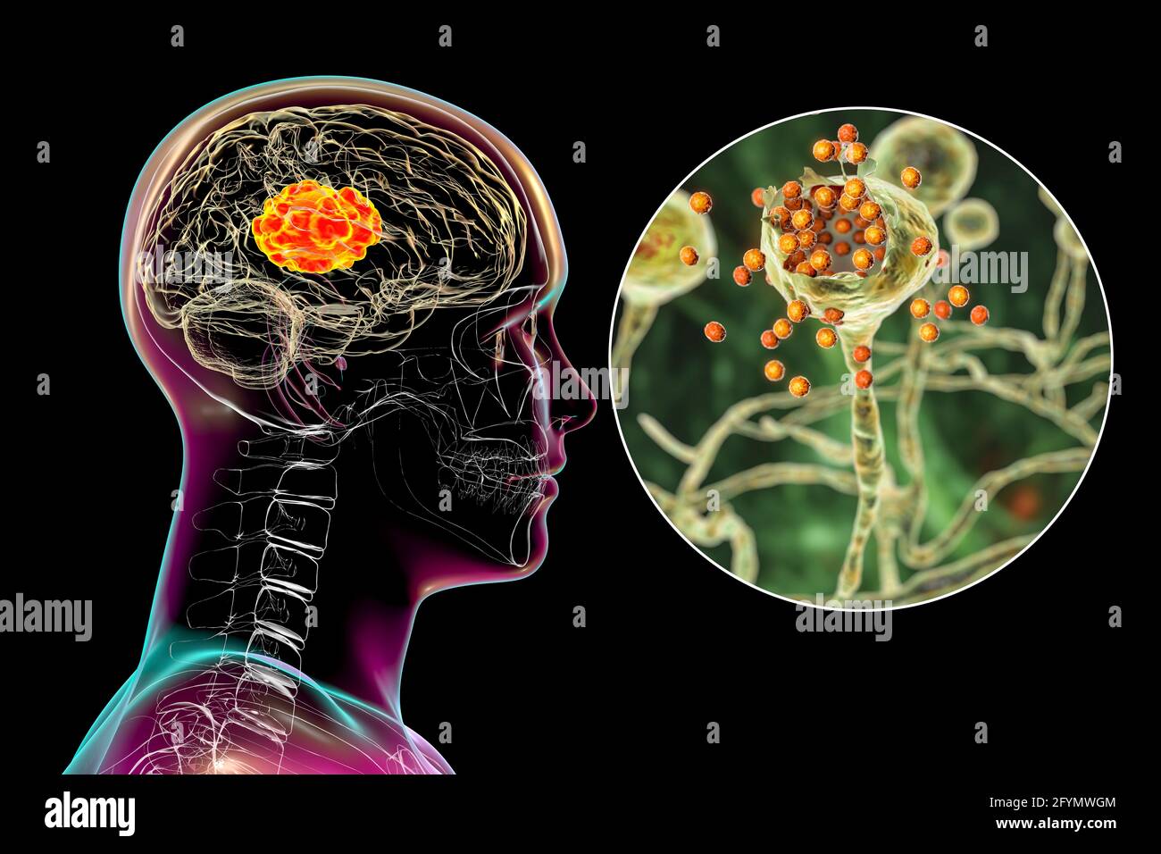 Brain mucormycosis, illustration Stock Photo - Alamy