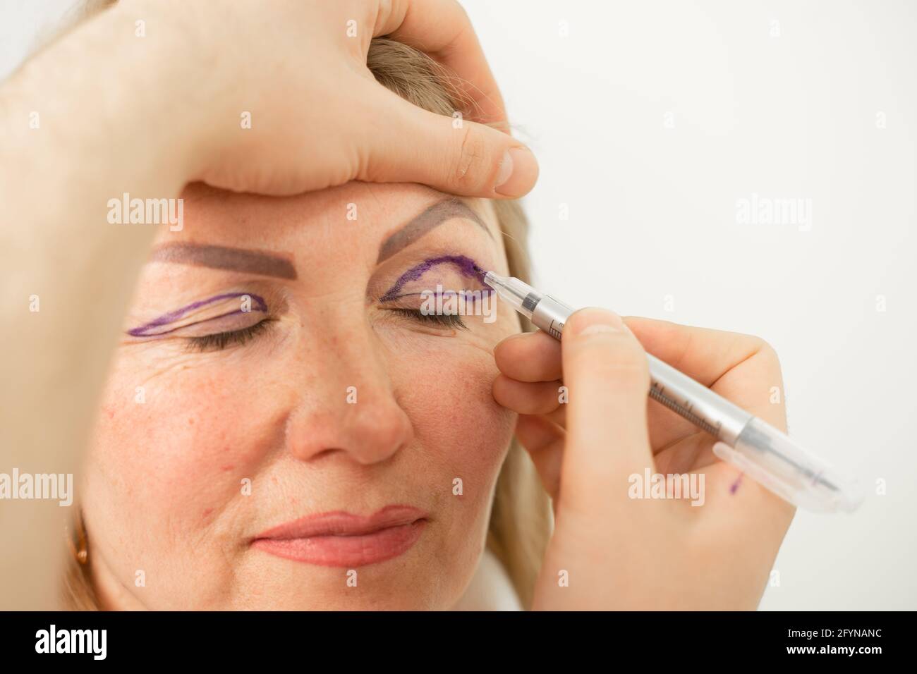 Blepharoplasty markup close-up on the face before the plastic surgery ...