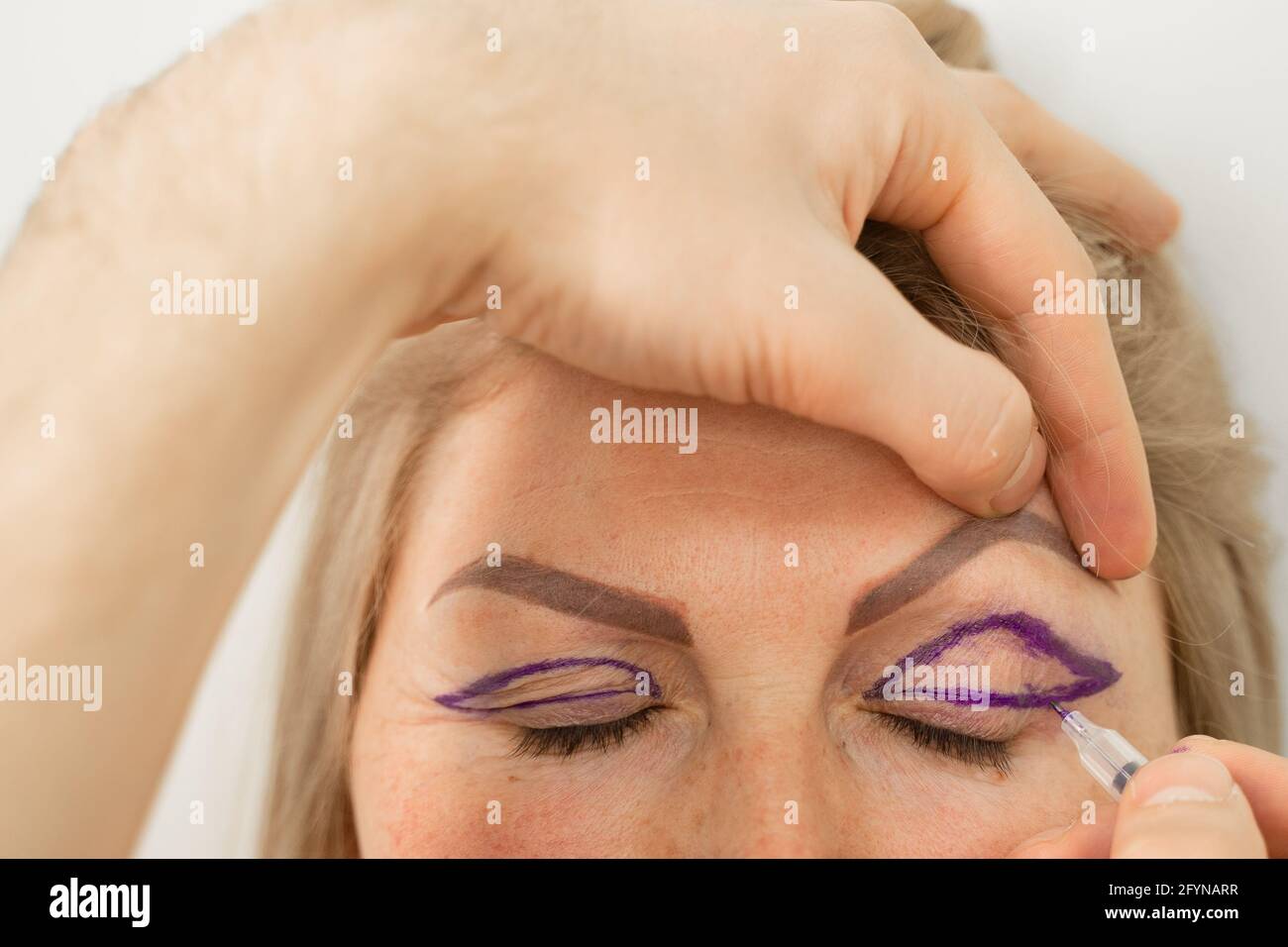 Blepharoplasty markup close-up on the face before the plastic surgery ...