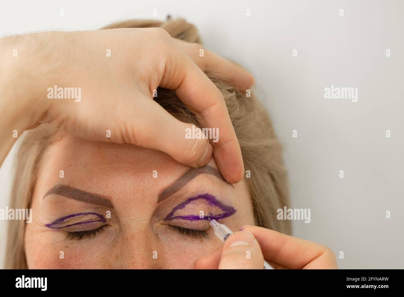 Blepharoplasty markup close-up on the face before the plastic surgery ...