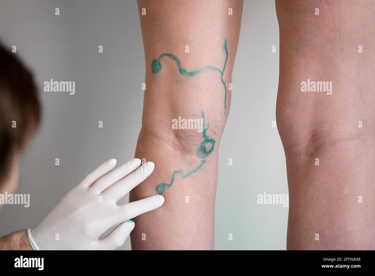 Vein markup. Vascular surgeon is marking veins for varicose surgery ...