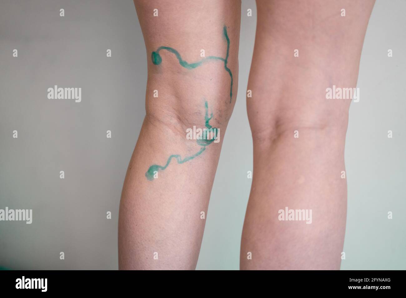 Vein markup. Vascular surgeon is marking veins for varicose surgery ...