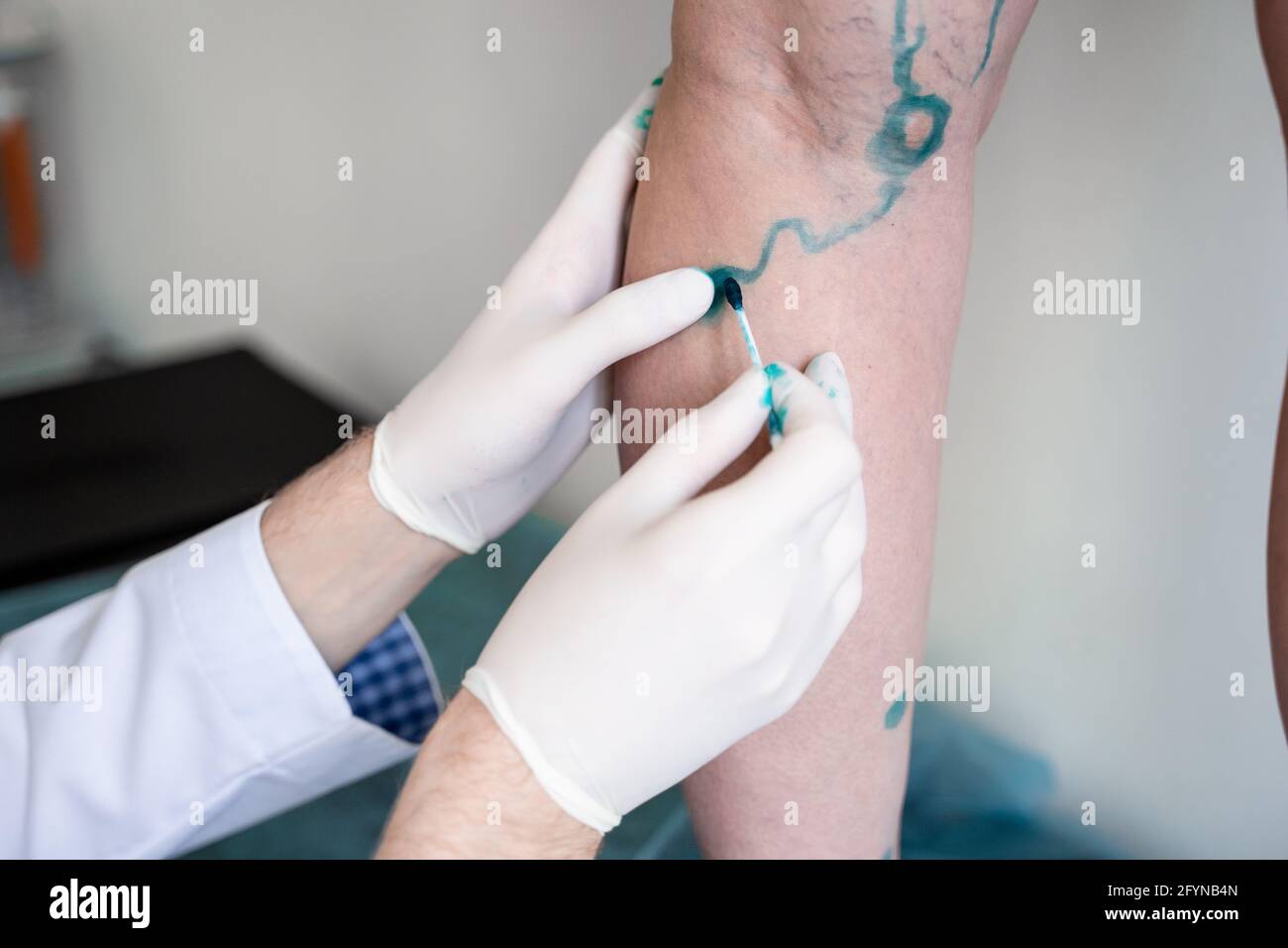 Vein markup. Vascular surgeon is marking veins for varicose surgery ...
