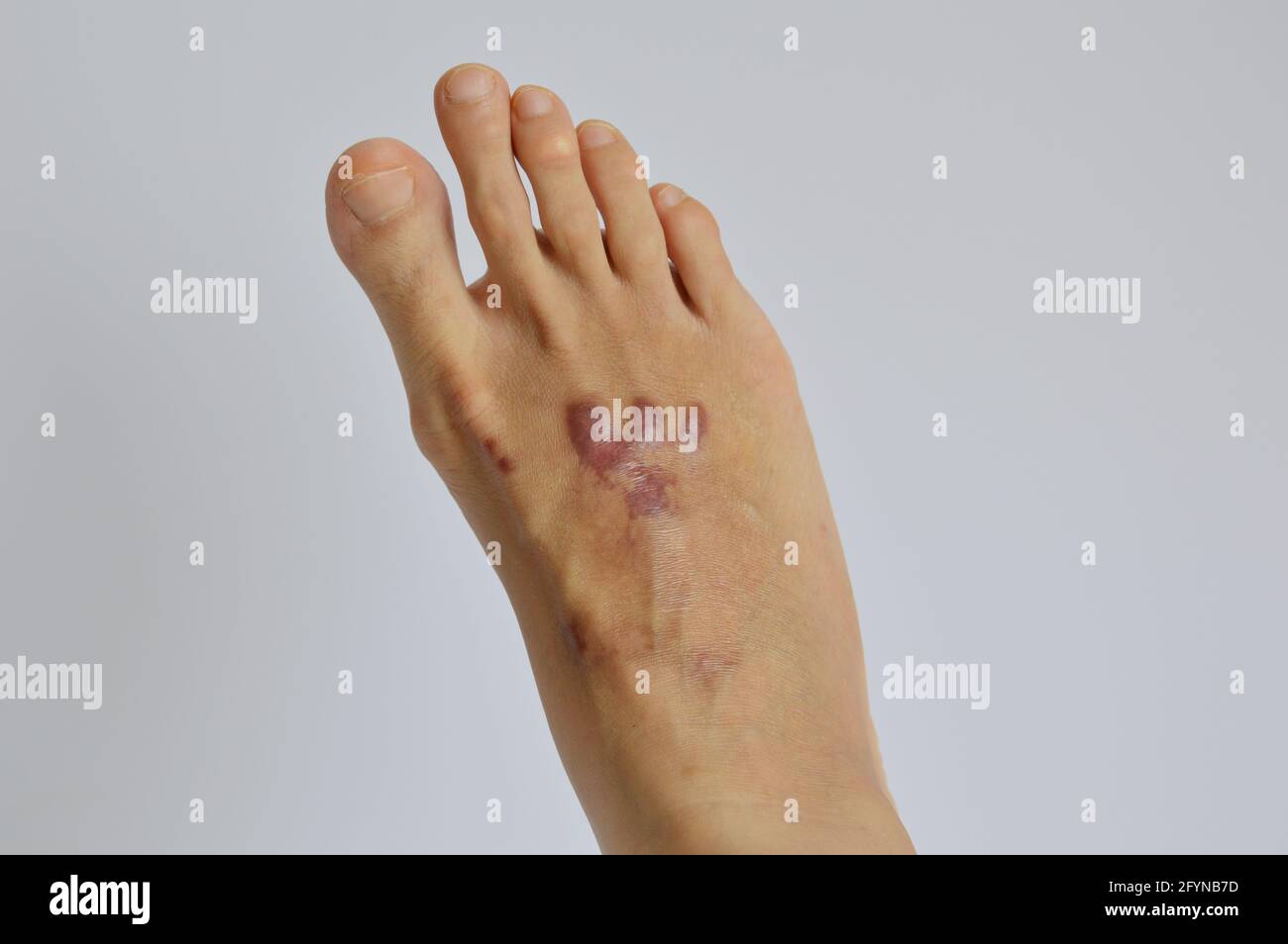 Foot pigmentation hi-res stock photography and images - Alamy
